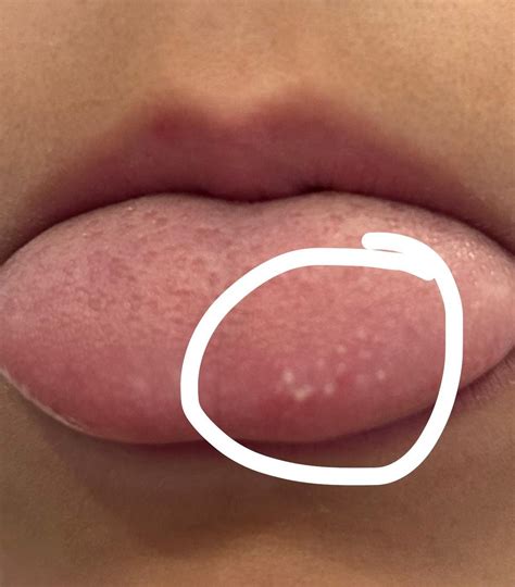 White Inflamed Looking Pimples On Tongue After Inflammation Raskdentists