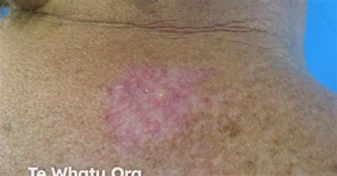Superficial Basal Cell Carcinoma Back Image