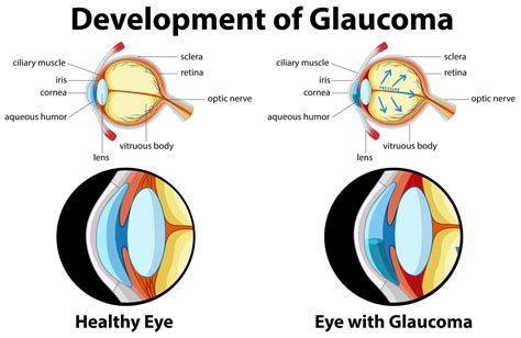 Glaucoma Pathophysiology Treatment Pharmacology Mentor