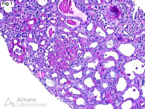 Diffuse Mesangial Sclerosis Teaching Points Arkana Laboratories
