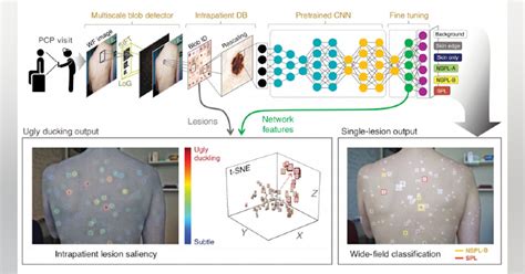 Deep Learning Based Melanoma Screening Tool Uses Ugly Duckling Method Vision Systems Design