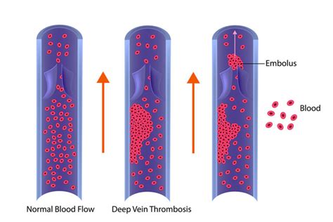 Symptoms Of Dvt In Legs New York Vein Treatment Center
