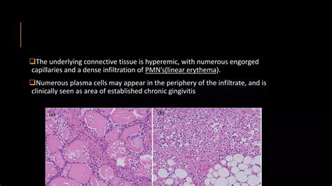 Acute Gingival Infections And Desquamative Gingivitis Ppt