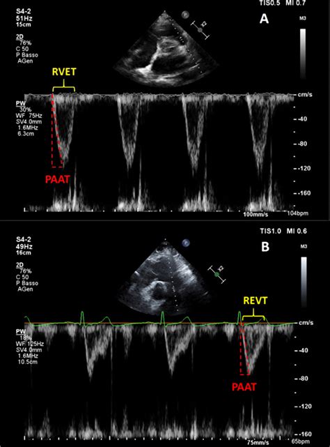 Pulmonary Artery Acceleration Time Accuracy For Systolic Pulmonary Artery Pressure Estimation In