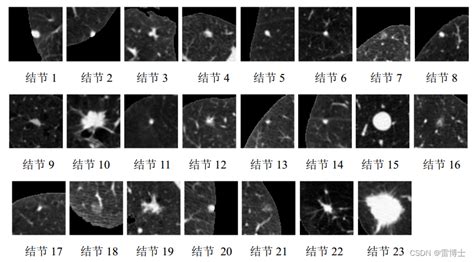 基于lidc Idri肺结节肺癌数据集的放射组学机器学习分类良性和恶性肺癌（python 全代码）全流程解析 （一）lidc数据集 Csdn博客
