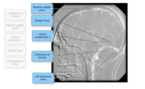 Solved Superior Sagittal Sinus Confluence Of Sinuses