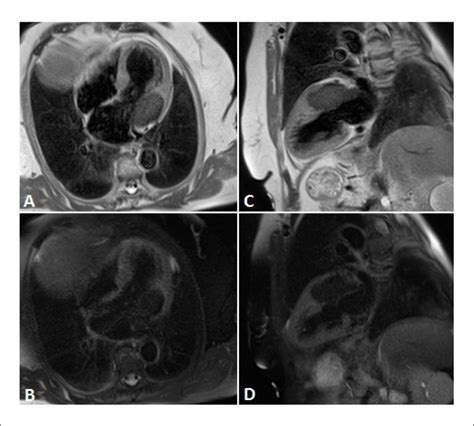 Bulky Mitral Annulus Caseous Calcification In An Atypical Location