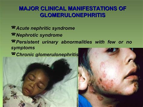 Glomerulonephritis Pdf