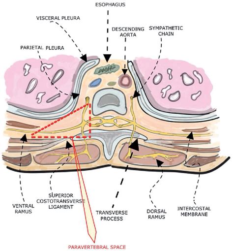 Figure 1 From Thoracal Paravertebral Block For Breast Surgery Meme Cerrahisi Için Torakal