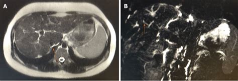Magnetic Resonance Cholangiography A Reduced Sized Liver With Download Scientific Diagram
