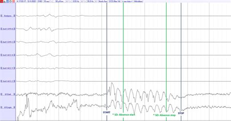 Example Of An Algorithm‐detected 3‐hz Spikewave Discharge Of ≥3 S On