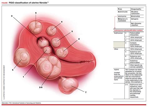 Pedunculated Uterine Fibroids