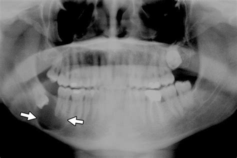 Jaw Cyst X Ray At Annie Burress Blog