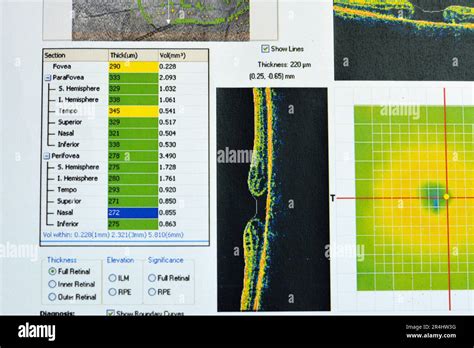 Oct Of The Eye Reveals Faint Epimacular Membrane And Full Thickness Macular Hole Involving The