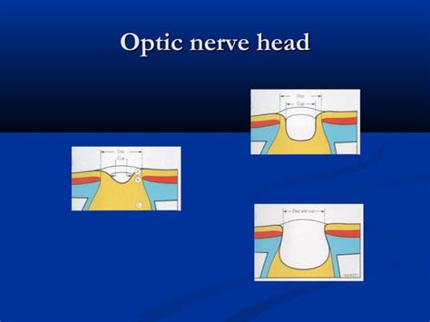Optic Nerve Head Evaluation Ppt