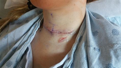 Thyroidectomy Album On Imgur