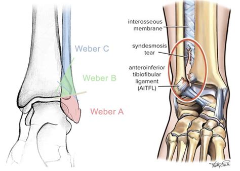 Weber Fractures — Kwak Talk
