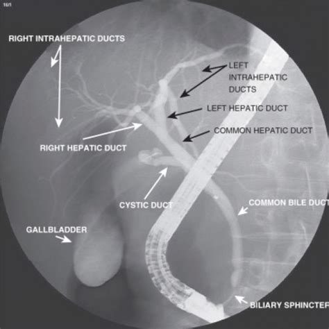 Cholangiogram Procedure