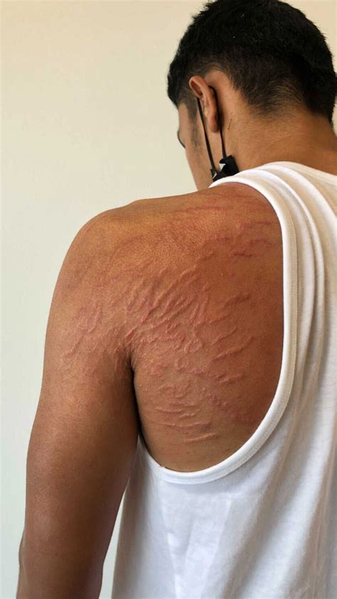 Tattoo Artist Helps People Hide Stretch Marks And Scars With Unique No Ink Method And Goes