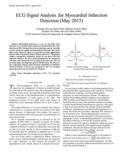 Ecg Signal Analysis For Myocardial Infarction Detection Pdf