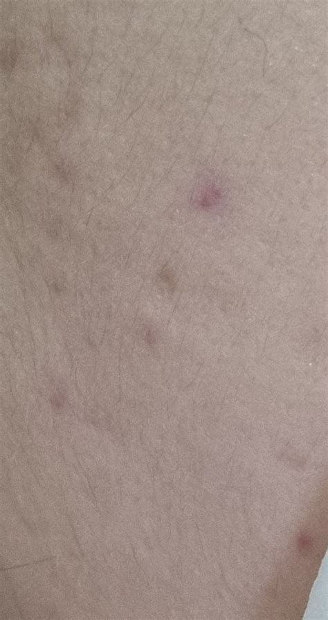 의사에게 물어보세요 얼굴 볼쪽 2년된 강남언니 1등 성형수술and피부시술 정보앱