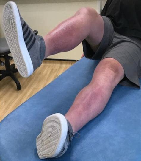 Side View Showing Straight Leg Raise And Residual Fixed Flexion