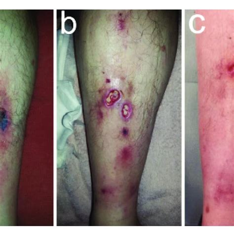 Nih Fletcher Criteria For Gist Risk Assessment Download Table