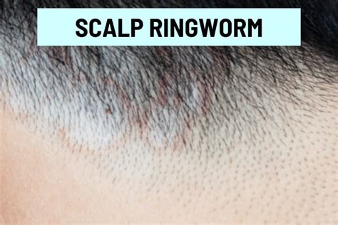 Red Spots On Scalp 11 Causes Pictures And Treatment