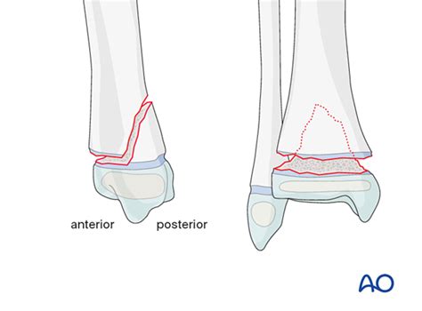Epiphysiolysis With Metaphyseal Wedge Salter Harris Ii Of The Distal Tibia