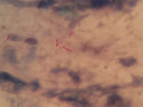 Tuberculosis Detection Object Detection Model By Fids