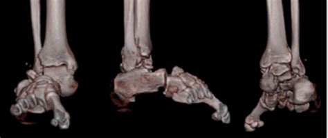 Subtalar Dislocations Are Divided Into Medial Lateral And