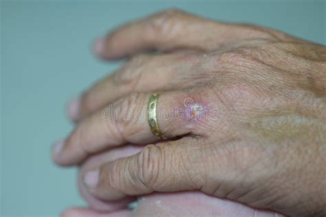 Problems Dry Skin Wound Scabs Stock Photo Image Of Detail Physique 303120804