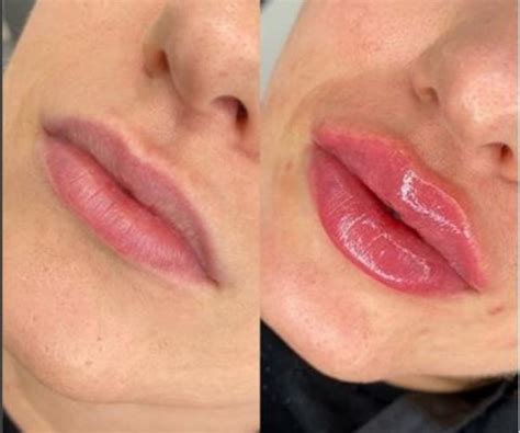 2ml Lip Filler Before And After Filler Aesthetic