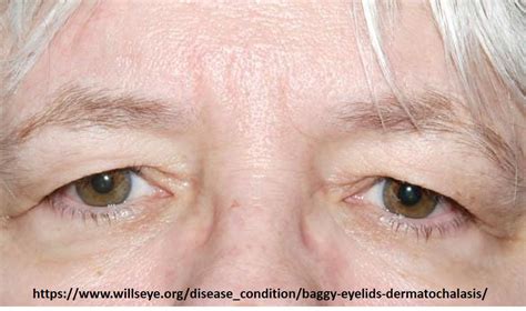 Plantagenet Droopy Eyelid At Marjorie Lockett Blog