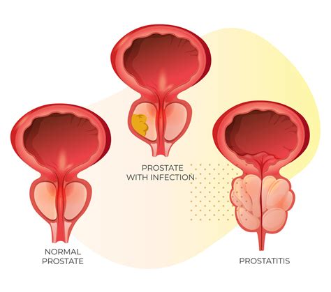 Prostatitis Treatment