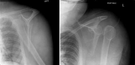 Scapular Y Views Of A Anterior And B Posterior Dislocation Of The