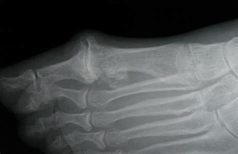 Δύσκαμπτο Μεγάλο Δάκτυλο Hand Surgery