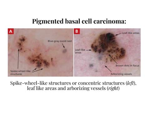 Dermoscopy — Dermapamine By Dermapamine Club