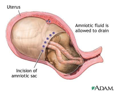C Section Series—procedure Part 4 Medlineplus Medical Encyclopedia