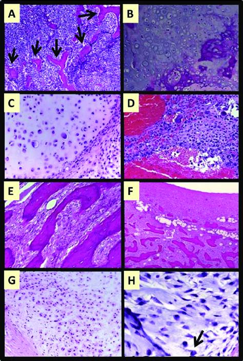 A Small Cell Osteosarcoma Permeating Normal Bone The Tumor Fills The Download Scientific