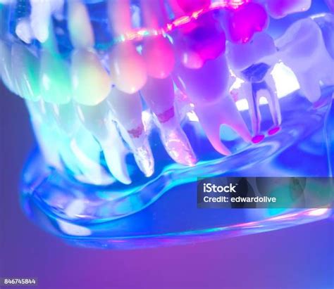 잇 몸 치아에 나 멜 플 라크 뿌리 및 금속 임 플 란 트 치과 치아 교정 치과 Teachng 모델 0명에 대한 스톡 사진 및 기타 이미지 Istock