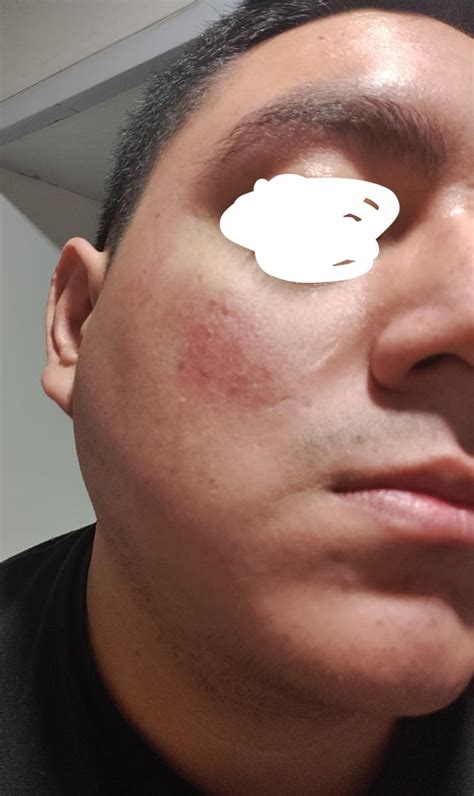 Red Cheeks And Pimples Rskincareaddiction