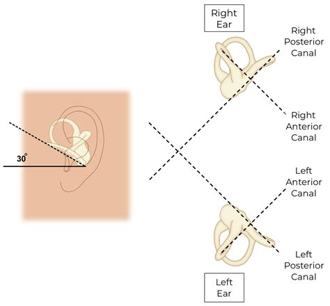 Teasing Out The Torsional Nystagmus With Bppv