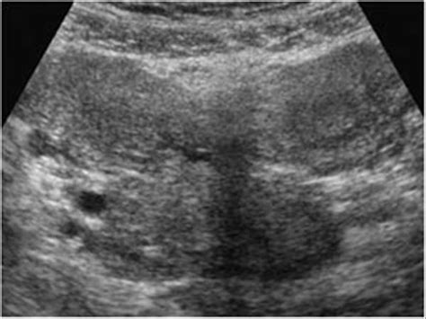 Gynaecology 31 Uterus Case 312 Miscellaneous Benign Uterine And