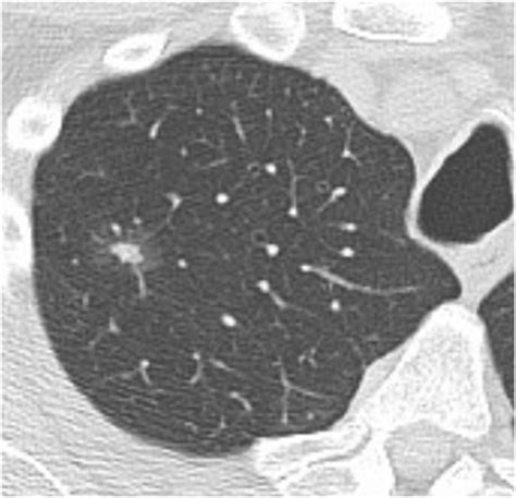 Subsolid Pulmonary Nodules Controversy And Perspective Pmc