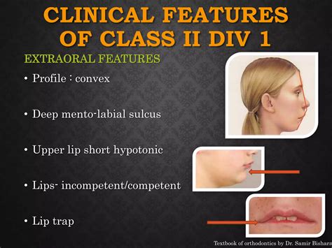Class Ii Malocclusion Pptx Dental Health Diseases And Conditions