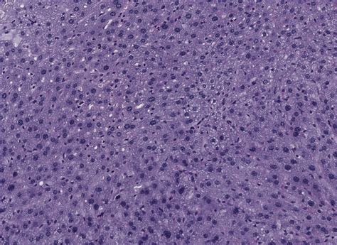 Aid In Analysis Of Pas Stained Slides Using Qupath Image Analysis