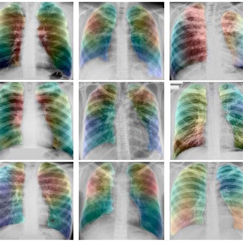 Gradcam Visualizations On X Ray Images Download Scientific Diagram