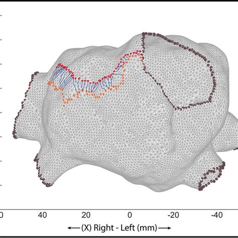 A Atrial Isochronal 3d Activation Map Of Perimitral Atrial Flutter