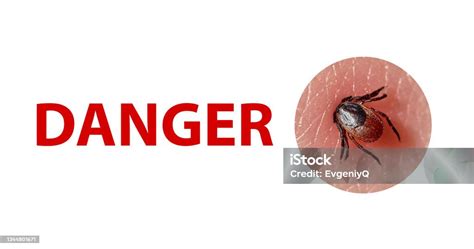 인간의 피부에 진드기 매크로 사진을 빠는 익소드 리시누스 부풀어 오른 기생충은 분홍색 자극표에 물린다 작은 빨간 방울 위험한